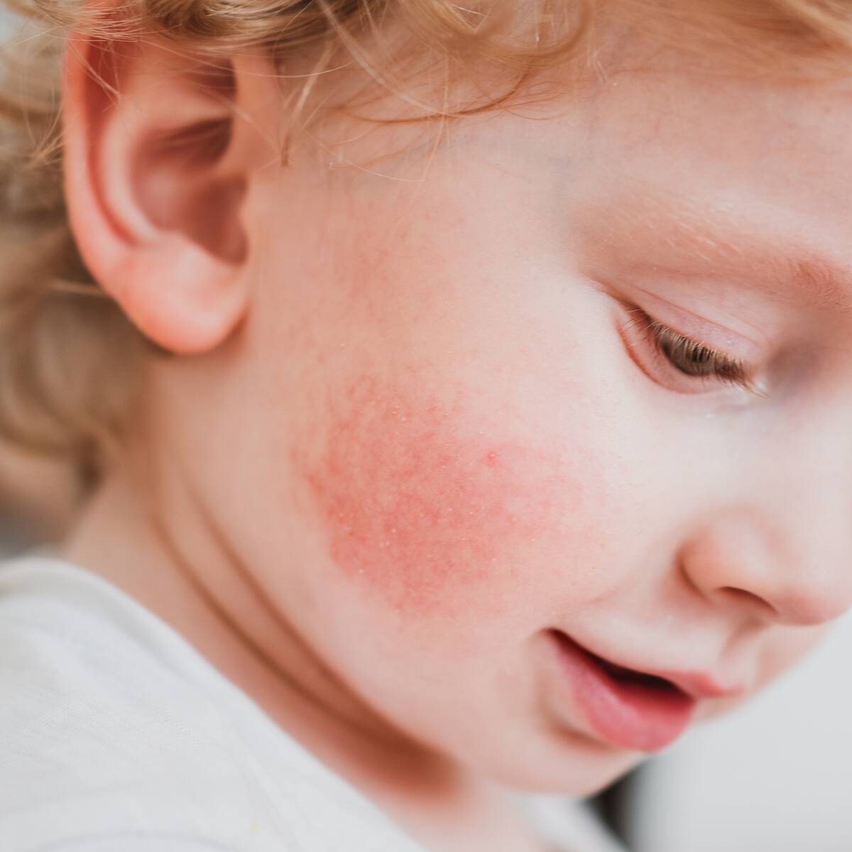When to Worry About a Rash in Adults: A Symptoms Guide