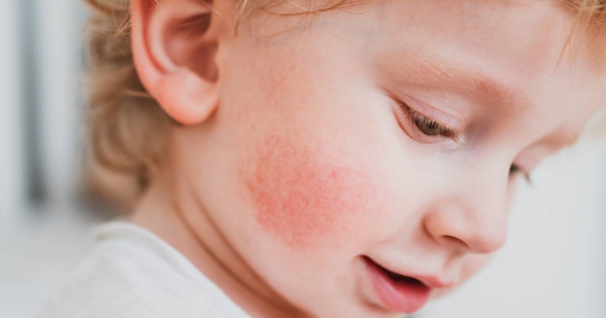 When to Worry About a Rash in Adults: A Symptoms Guide