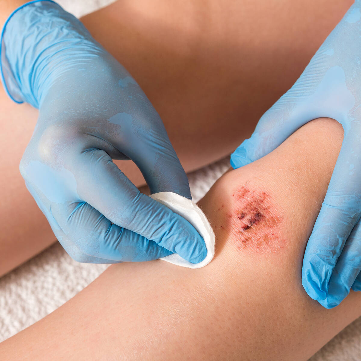 How to Tell if a Wound Is Healing or Infected